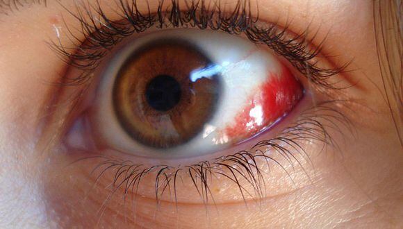 Mujer: ¿Cómo debemos actuar ante un derrame de ojos? | NOTICIAS OJO PERÚ
