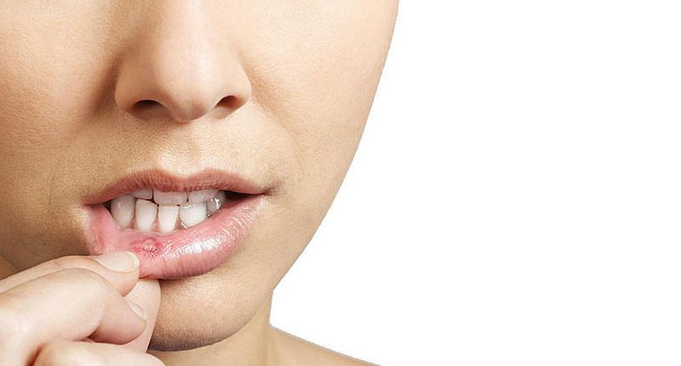 ¿Qué son los aftas? Conoce sus causas y cómo prevenirlo | MUJER | OJO