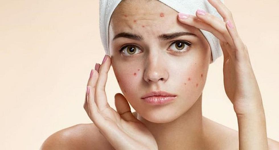5 cosas que debes saber sobre el acné | MUJER | OJO