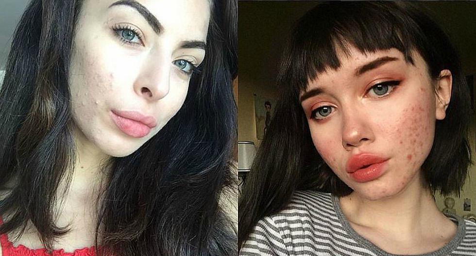 Acné se convierte en tendencia en Instagram y reinvindica la belleza ...