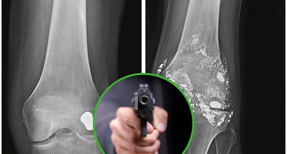 Hombre recibió un impacto de bala hace 14 años y recién ahora le causa ...